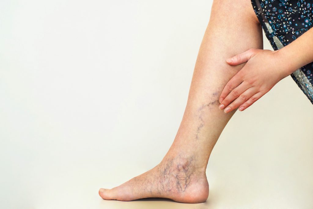 Clear V™ - Laser Vein Treatment | Revitalize U