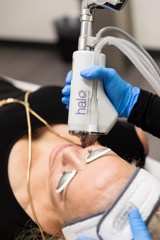 Halo Hybrid Fractional Laser Resurfacing | Revitalize U