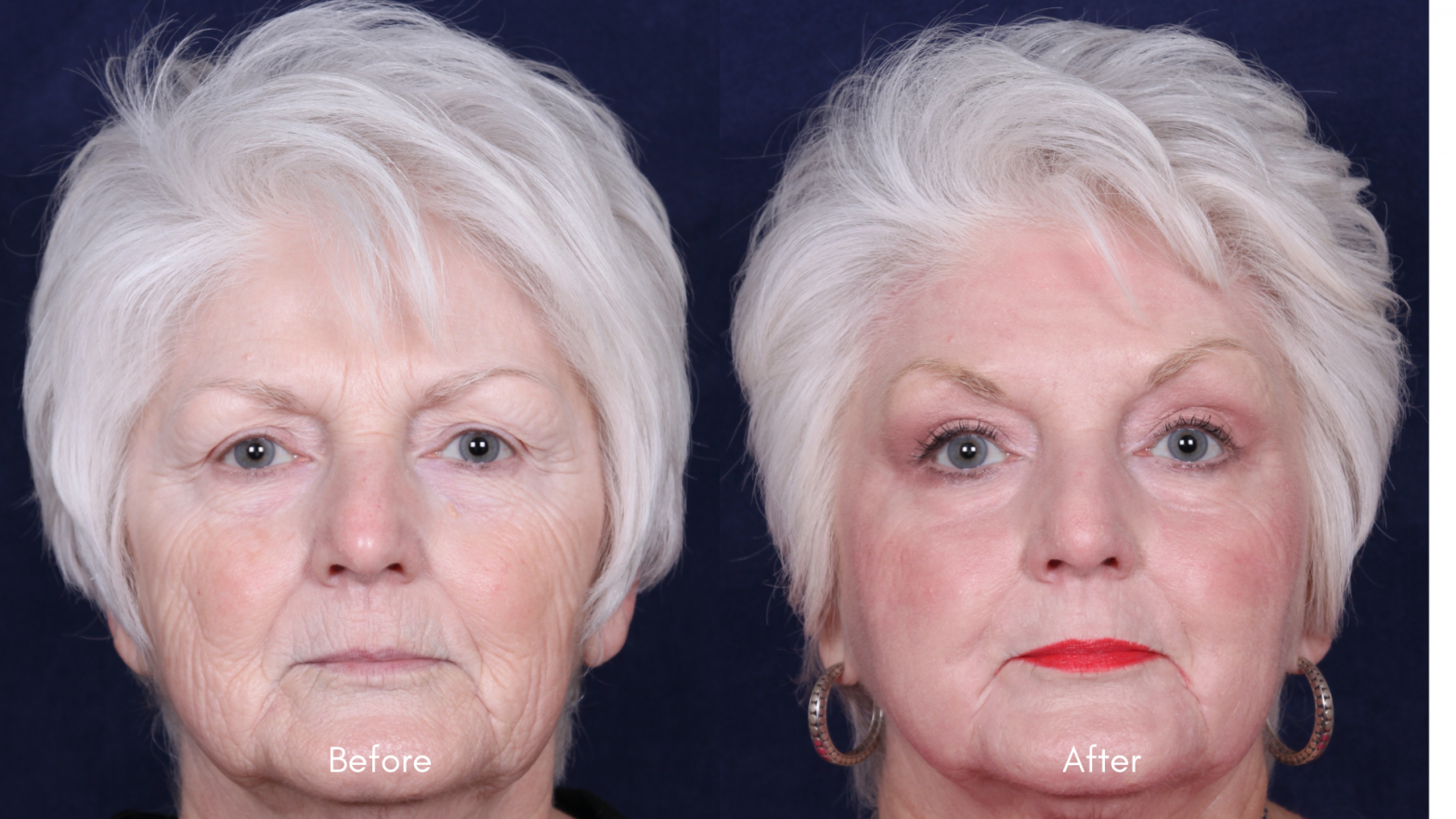 Brow & Forehead Lift | Revitalize U