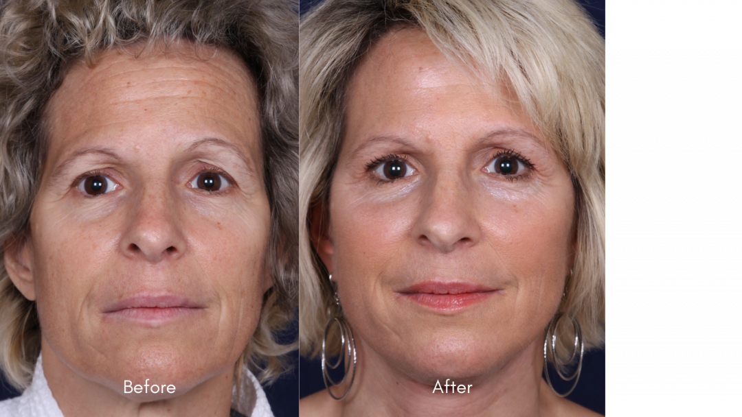 Facelift | Revitalize U