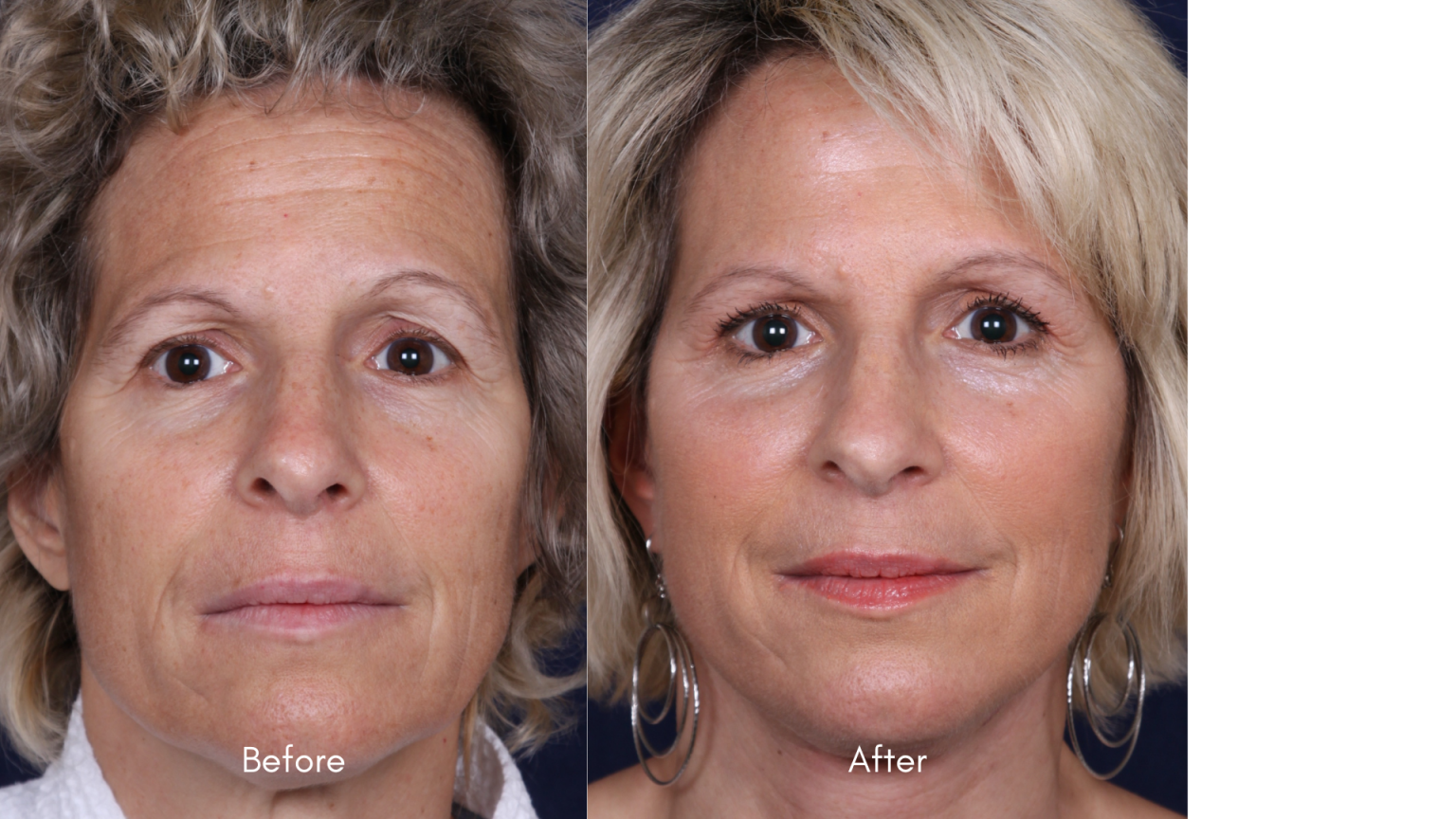 Facelift | Revitalize U